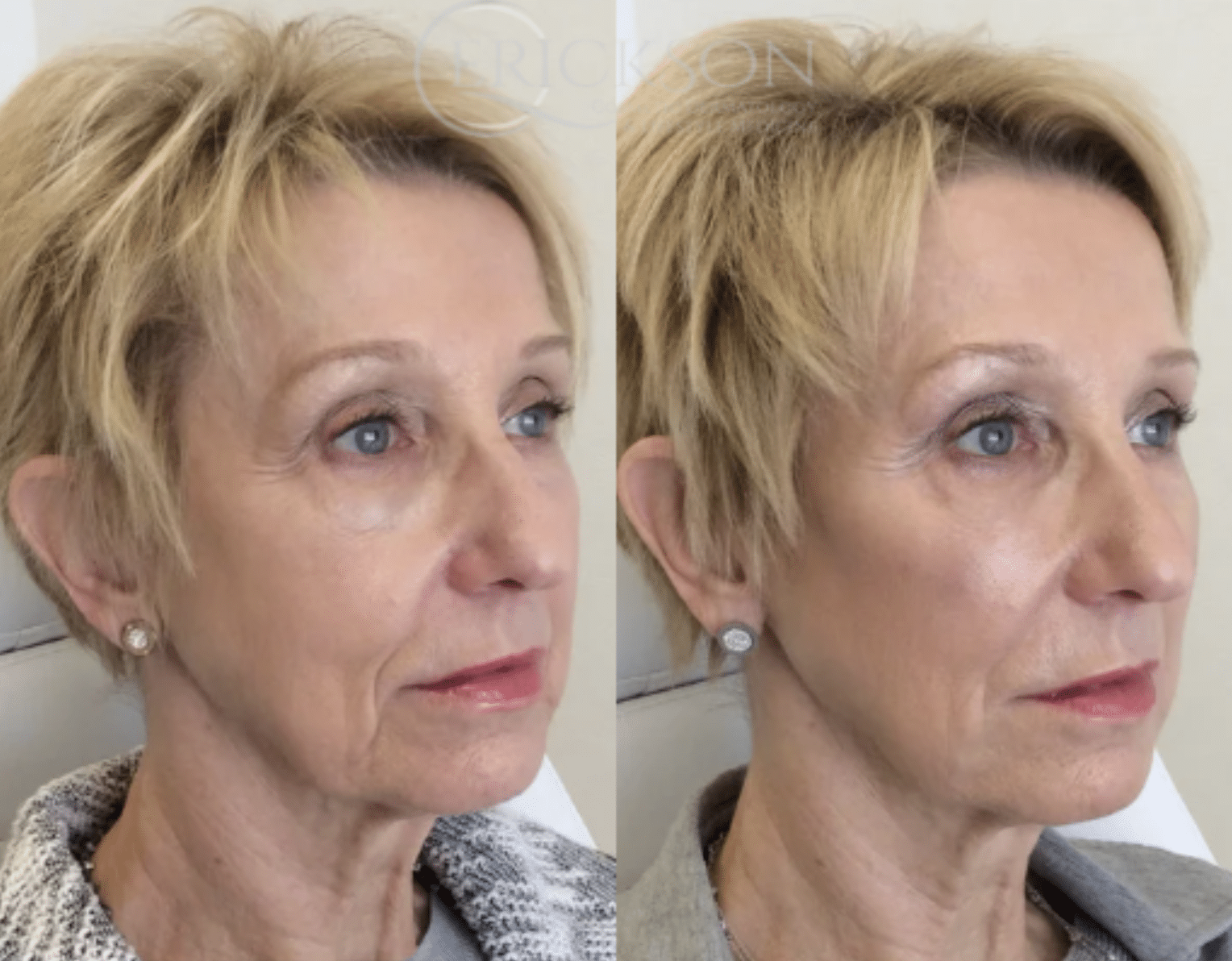 Before & After Gallery | Erickson Cosmetic Dermatology